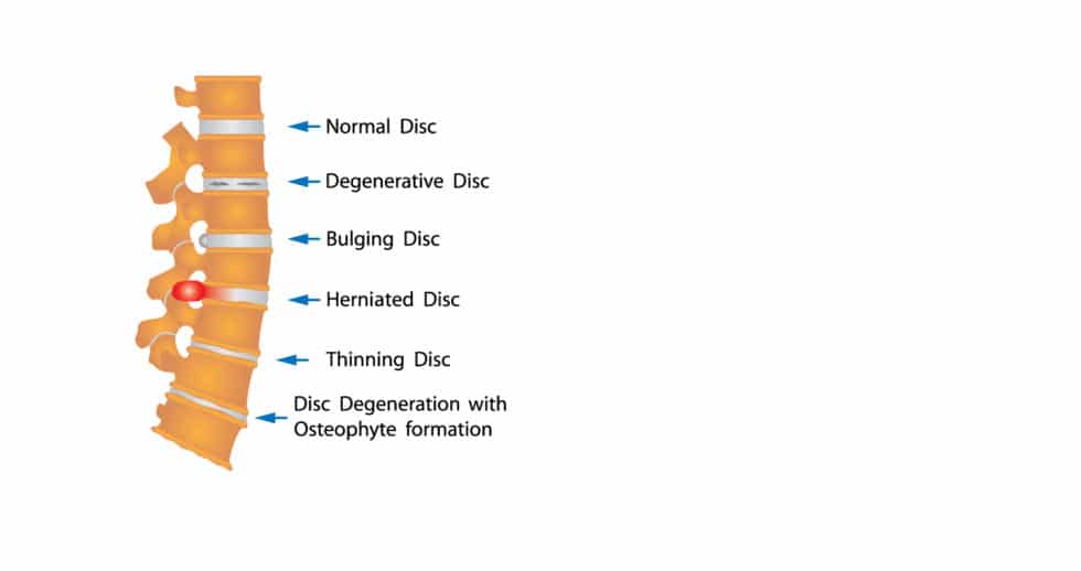 How Does Traction Help Back Pain? | Dr. David Warwick